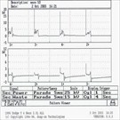 1996 Dodge Neon, Ignition - Secondary Waveform - iATN